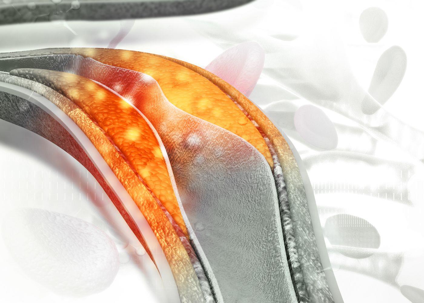 Što predstavlja visoka razina kolesterola u krvi i koliko je to opasno ...